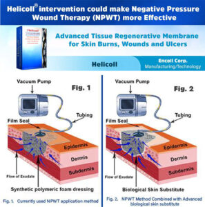 Helicoll® is a bioengineered high-purity Type-I collagen (>97% pure)